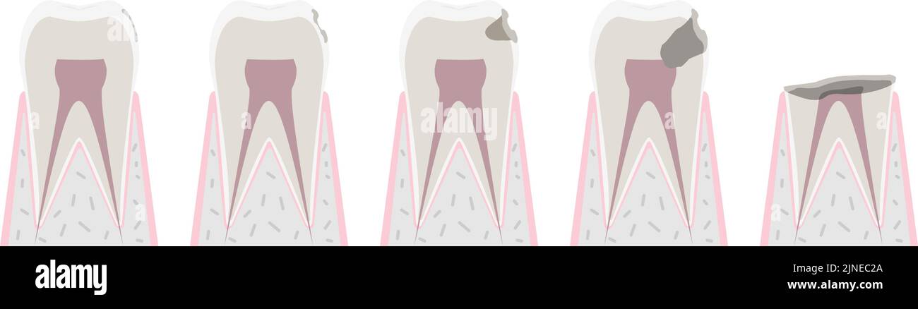Illustration of progress of tooth decay Stock Vector Image & Art - Alamy