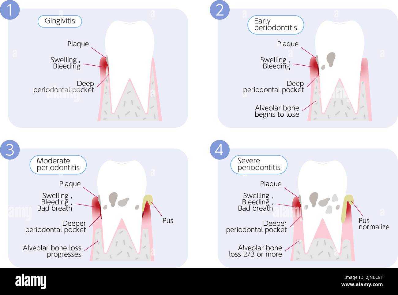 Periodontal disease progression illustration, 4 stages Stock Vector ...