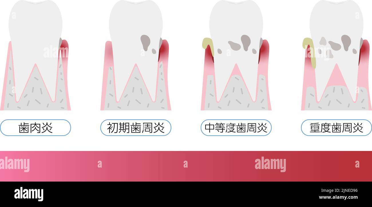 Illustration by stage of periodontal disease: order of progress ...
