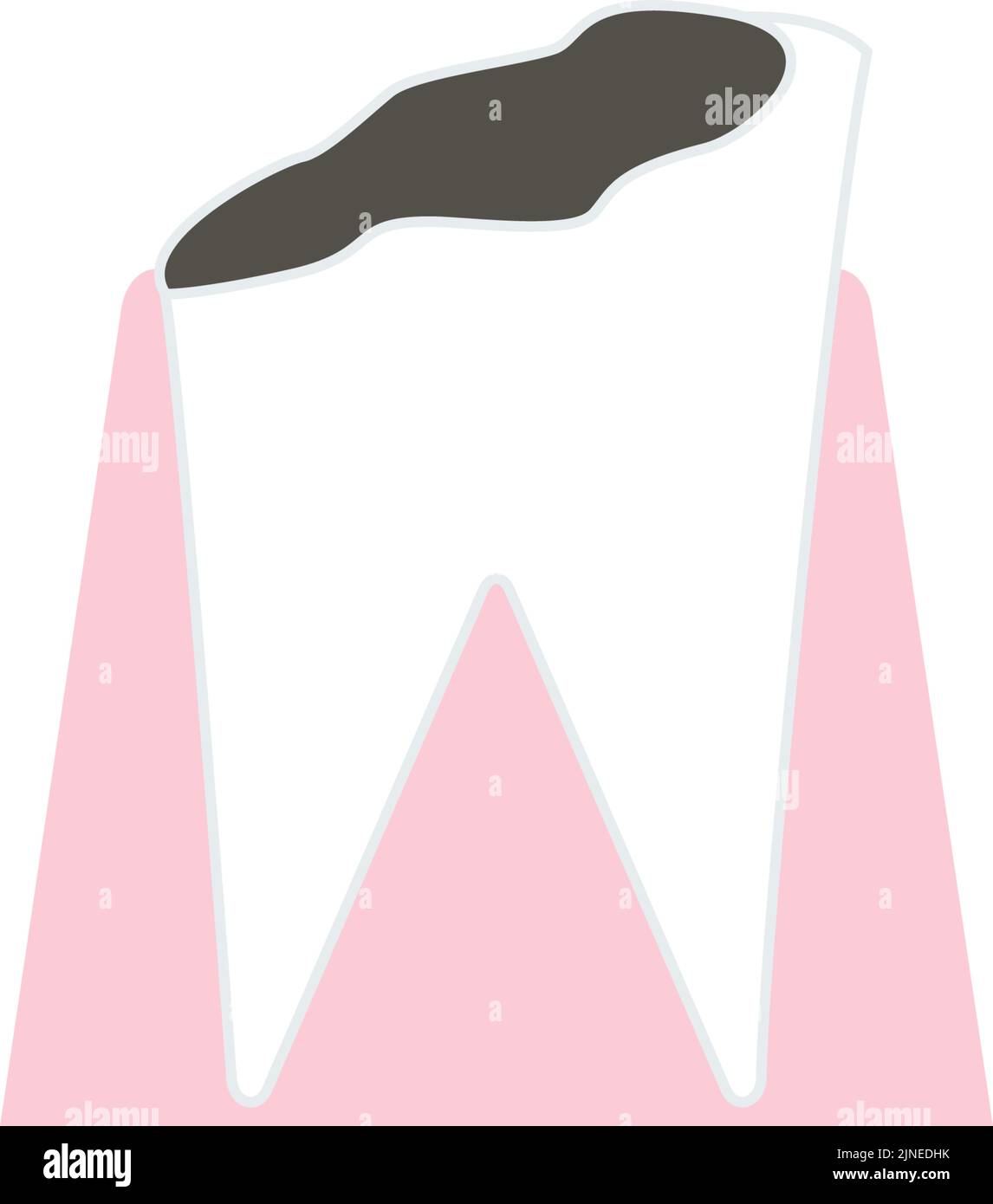 Progress of caries, only the root of the tooth remains with caries ...