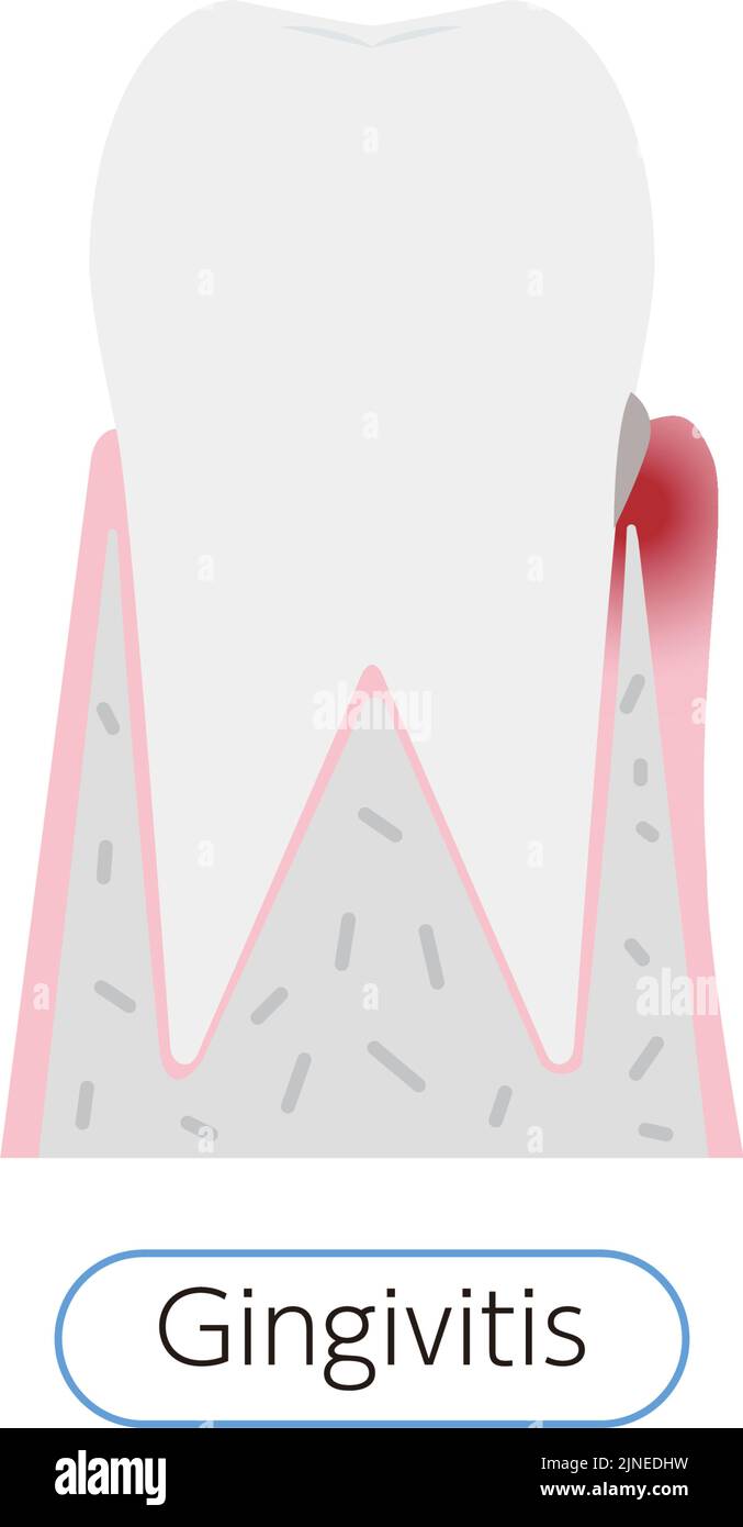 An image of gingivitis Stock Vector Images - Alamy