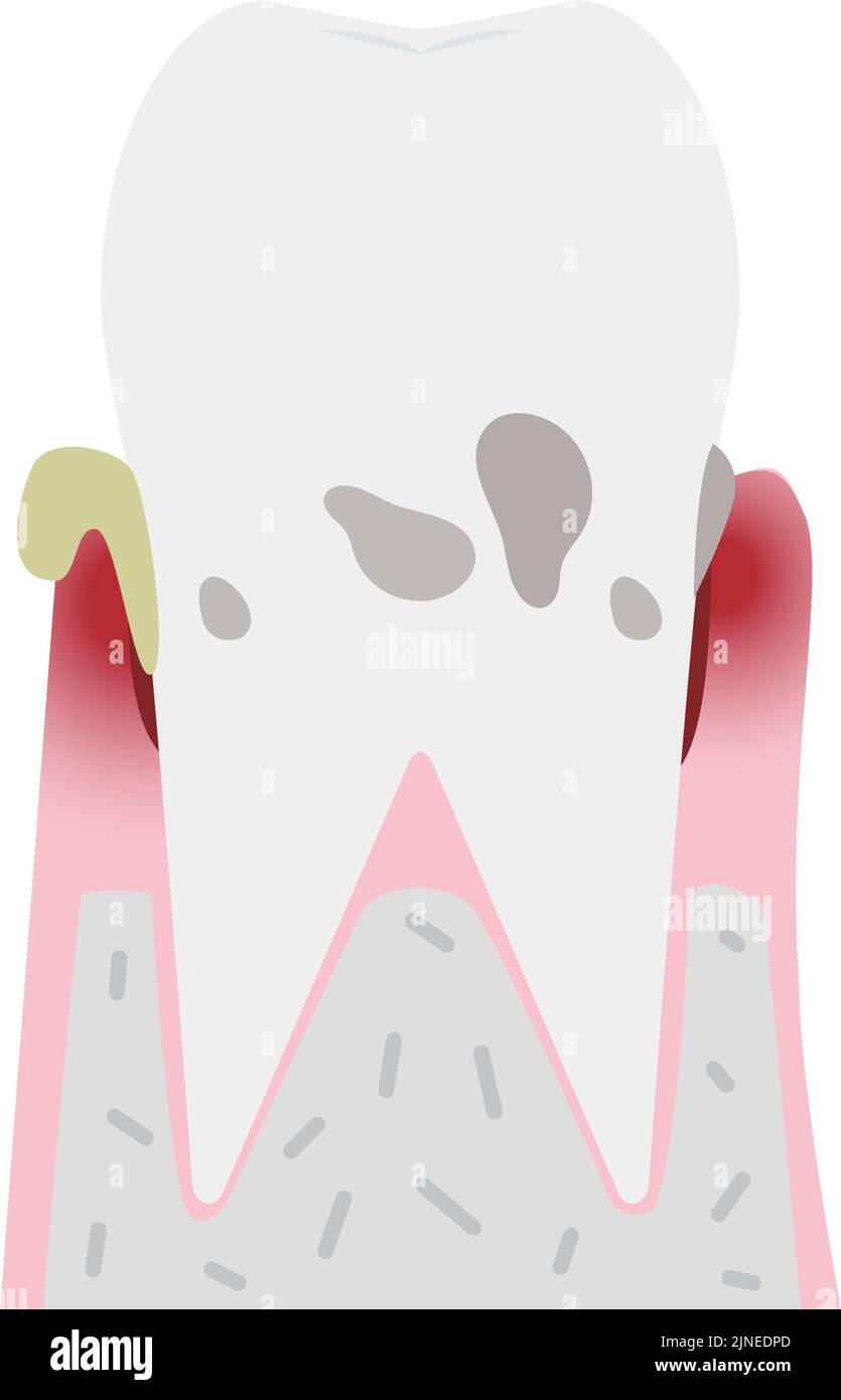 Illustration by stage of periodontal disease: moderate periodontitis ...