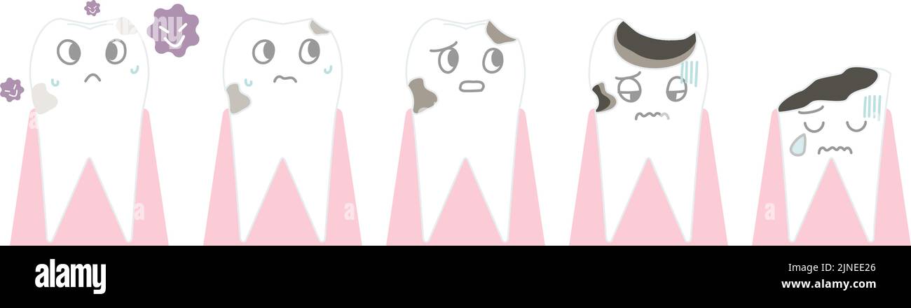 Illustration of progress of tooth decay Stock Vector Image & Art - Alamy