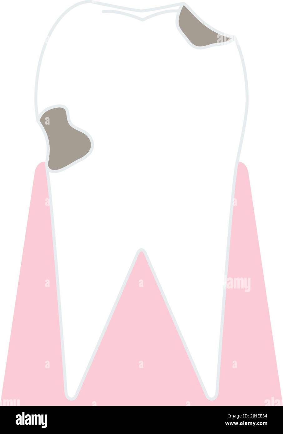 Progress of caries, caries reach dentin Stock Vector Image & Art - Alamy