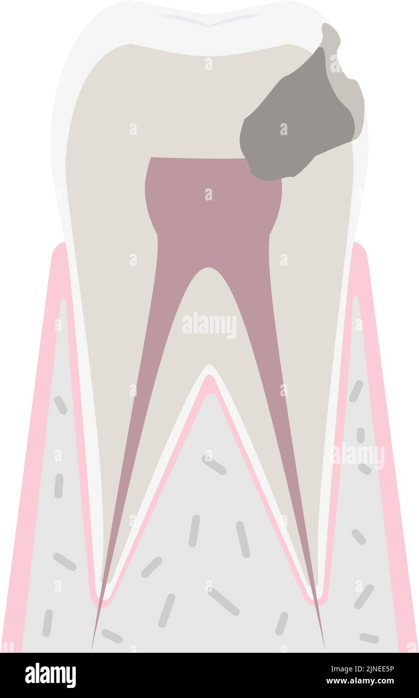 Progress of caries, caries reach the tooth nerve Stock Vector Image ...