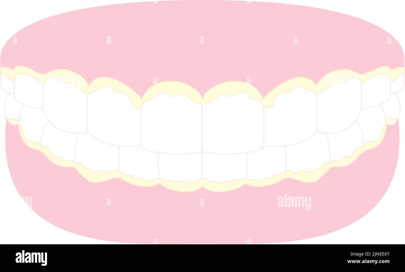 Illustration of plaque sticky teeth and gums Stock Vector Image & Art ...