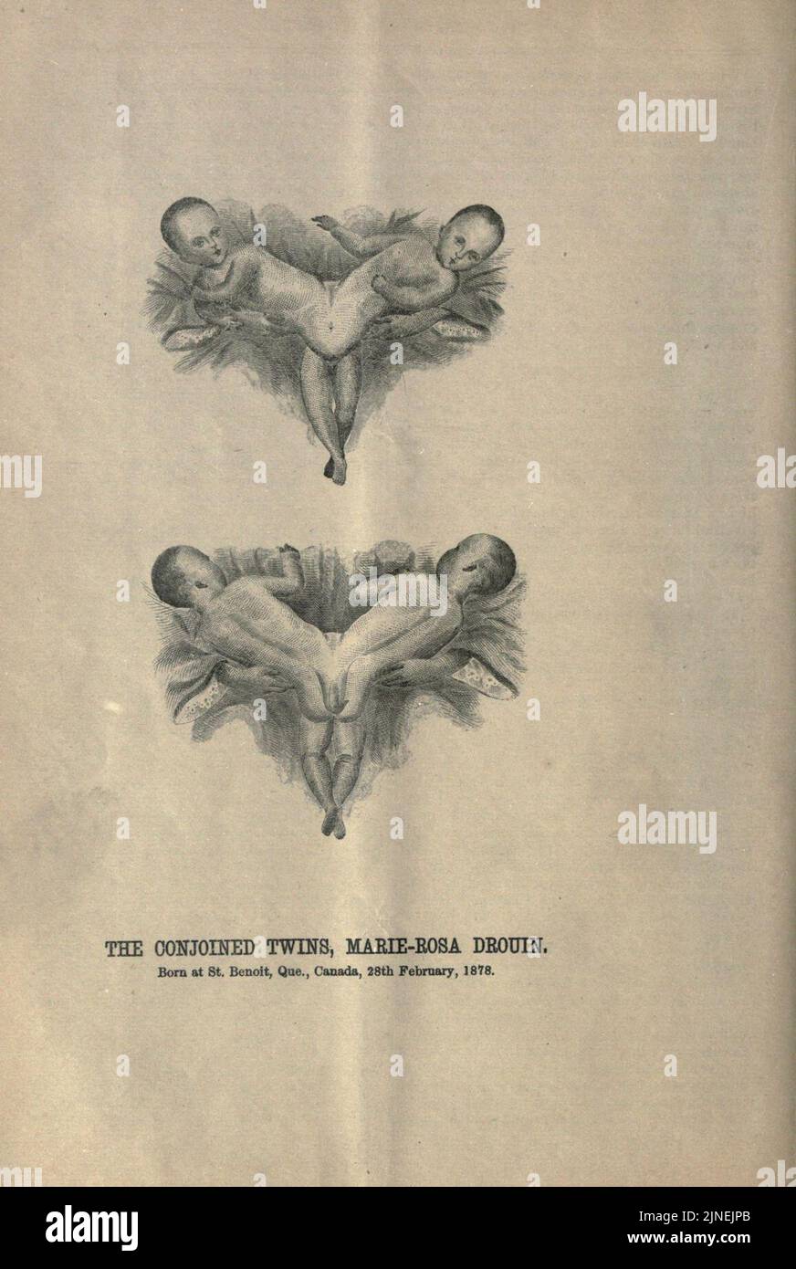 The Conjoined Twins, Marie-Rosa Drouin Stock Photo - Alamy