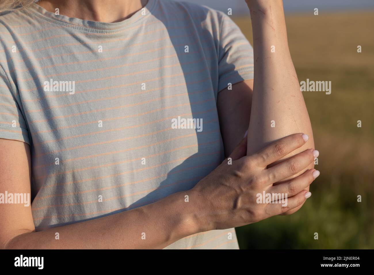 woman showing abrasions and scratches on her arm. High quality photo ...