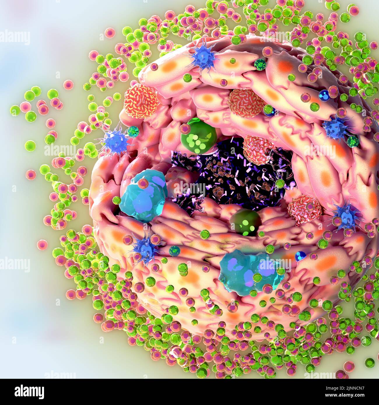 Structure of a tuberculous granuloma, illustration Stock Photo - Alamy