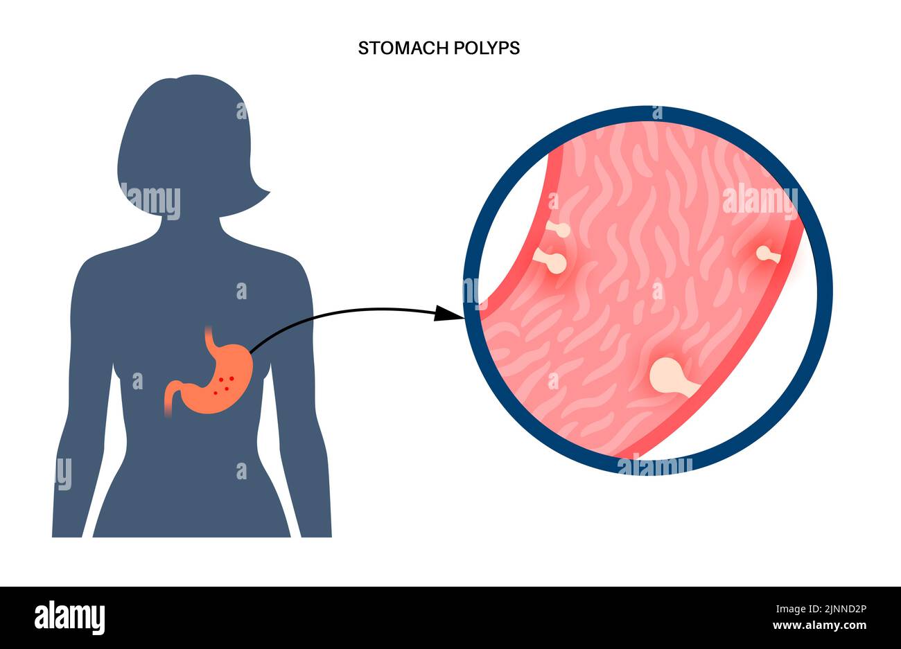 Stomach polyps, illustration Stock Photo - Alamy