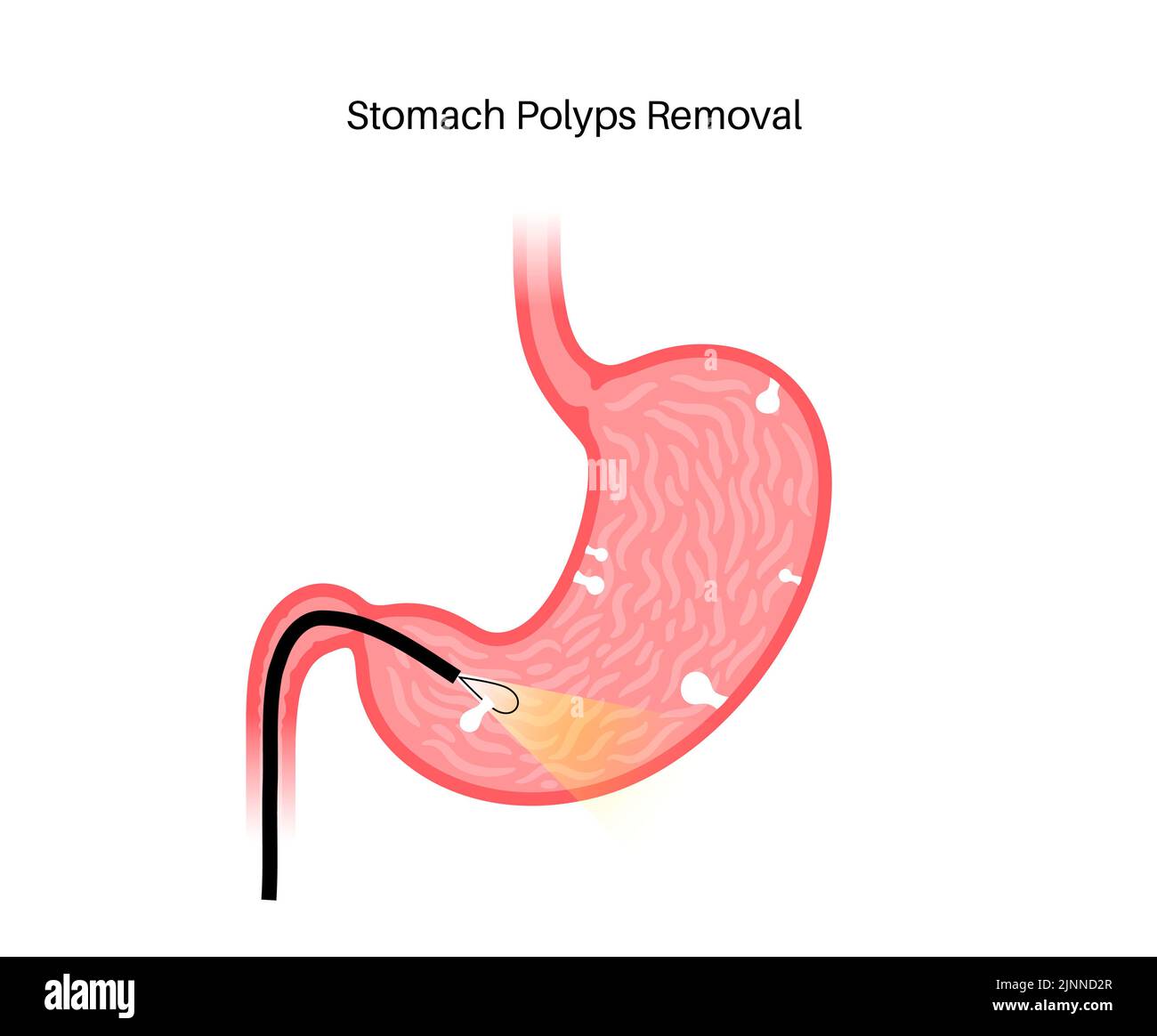 Stomach polyp removal, illustration Stock Photo - Alamy