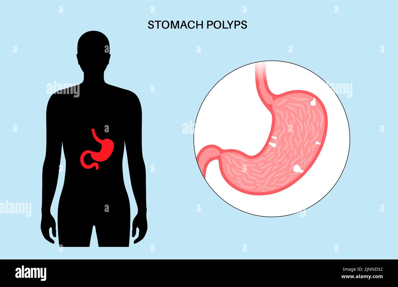 Stomach polyps, illustration Stock Photo - Alamy