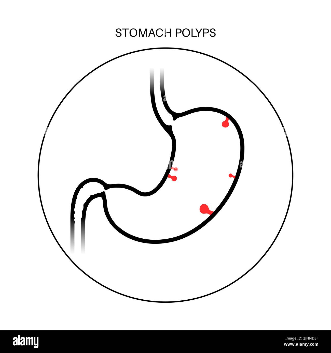Gastric polyp Cut Out Stock Images & Pictures - Alamy