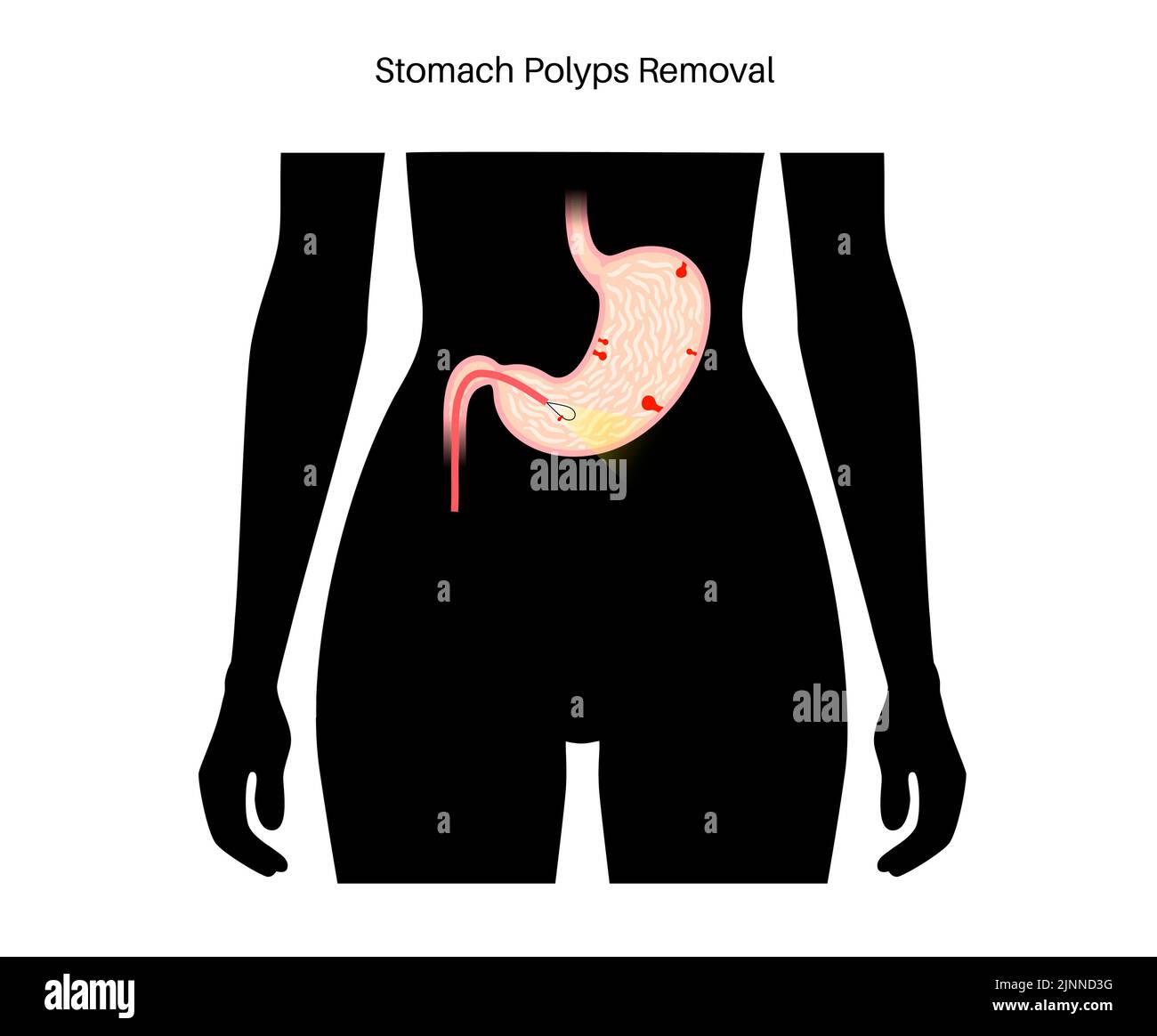 Stomach polyp removal, illustration Stock Photo - Alamy