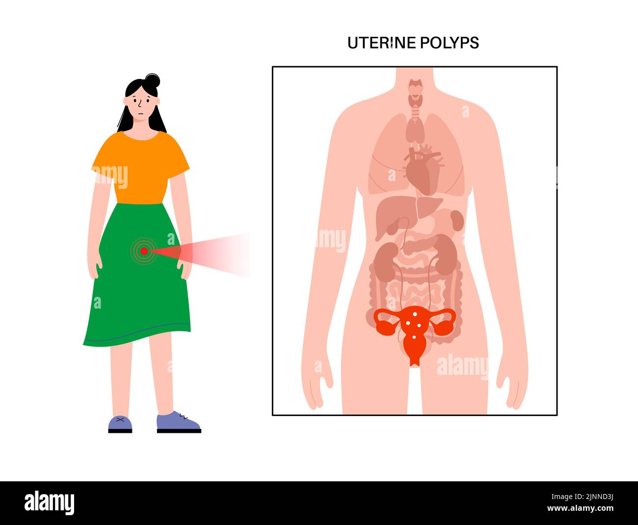 Uterine polyps, illustration Stock Photo - Alamy