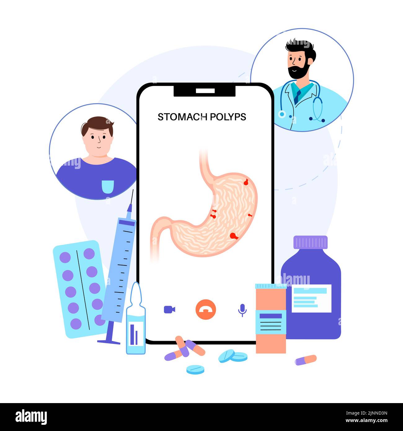 Stomach polyps, illustration Stock Photo - Alamy