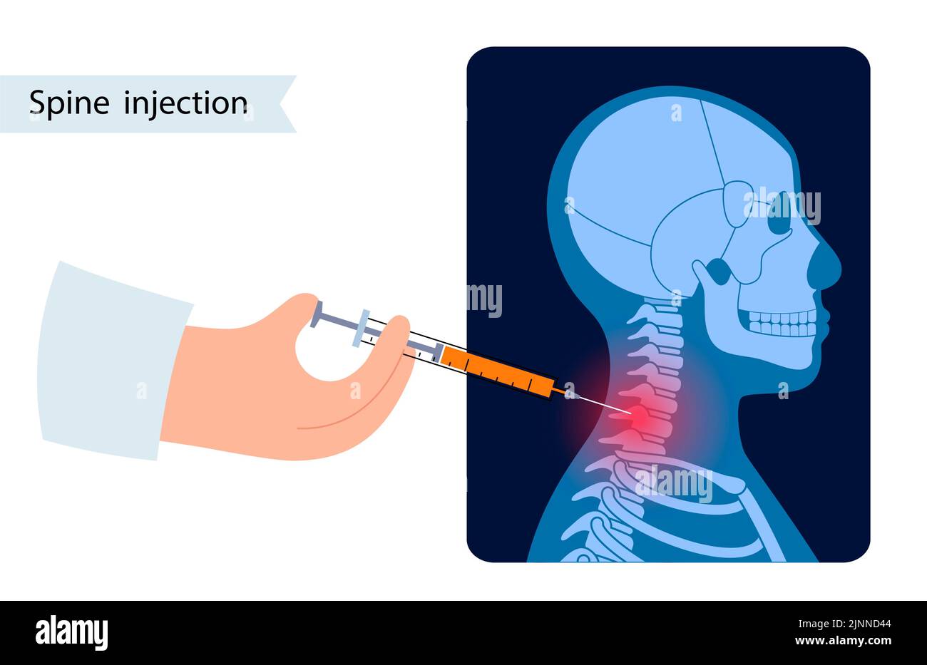 Lumbar epidural injection hi-res stock photography and images - Alamy