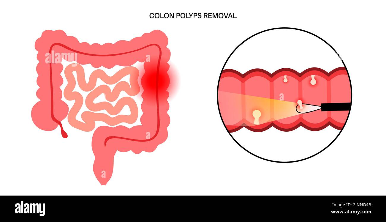 Colon polyps, illustration Stock Photo - Alamy