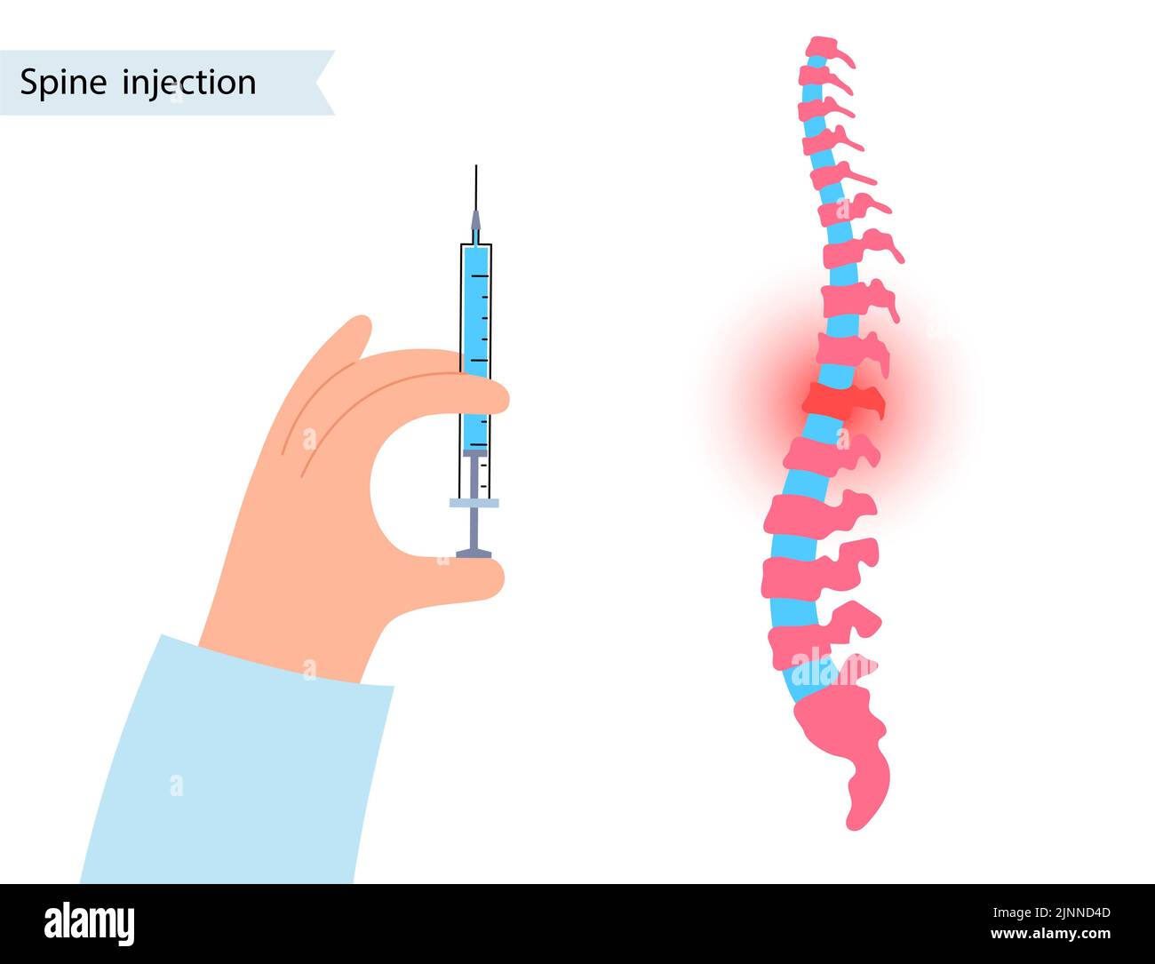 Lumbar epidural injection hi-res stock photography and images - Alamy