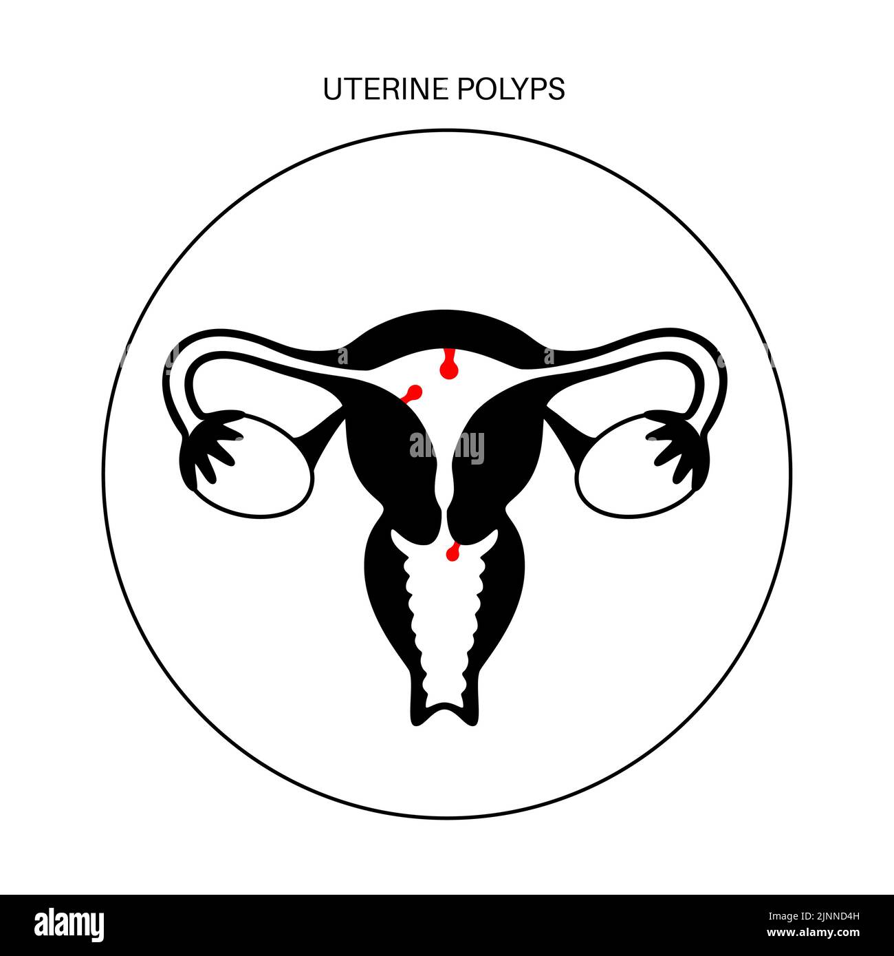 Uterine polyps, illustration Stock Photo - Alamy