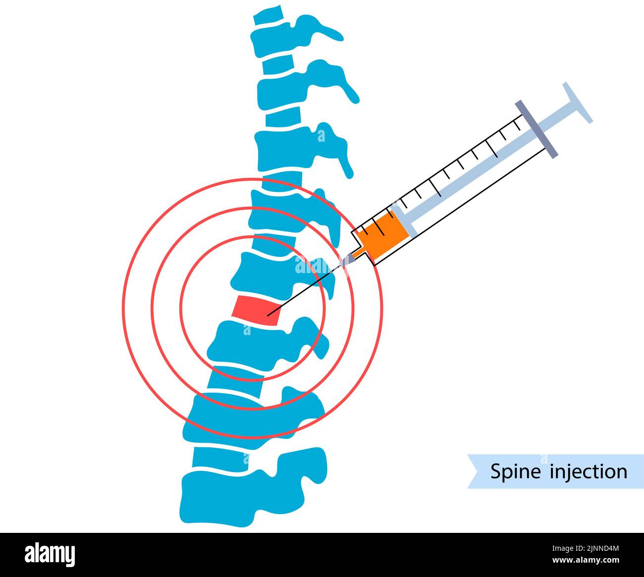 Spinal nerve block hi-res stock photography and images - Alamy