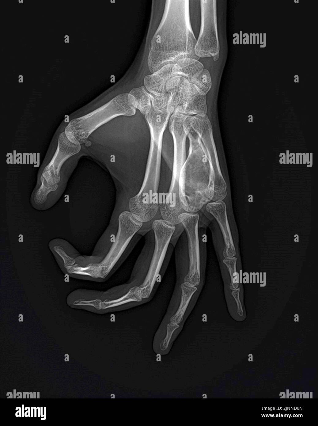 Can You See A Cyst On An Xray At Hamish Hale Blog