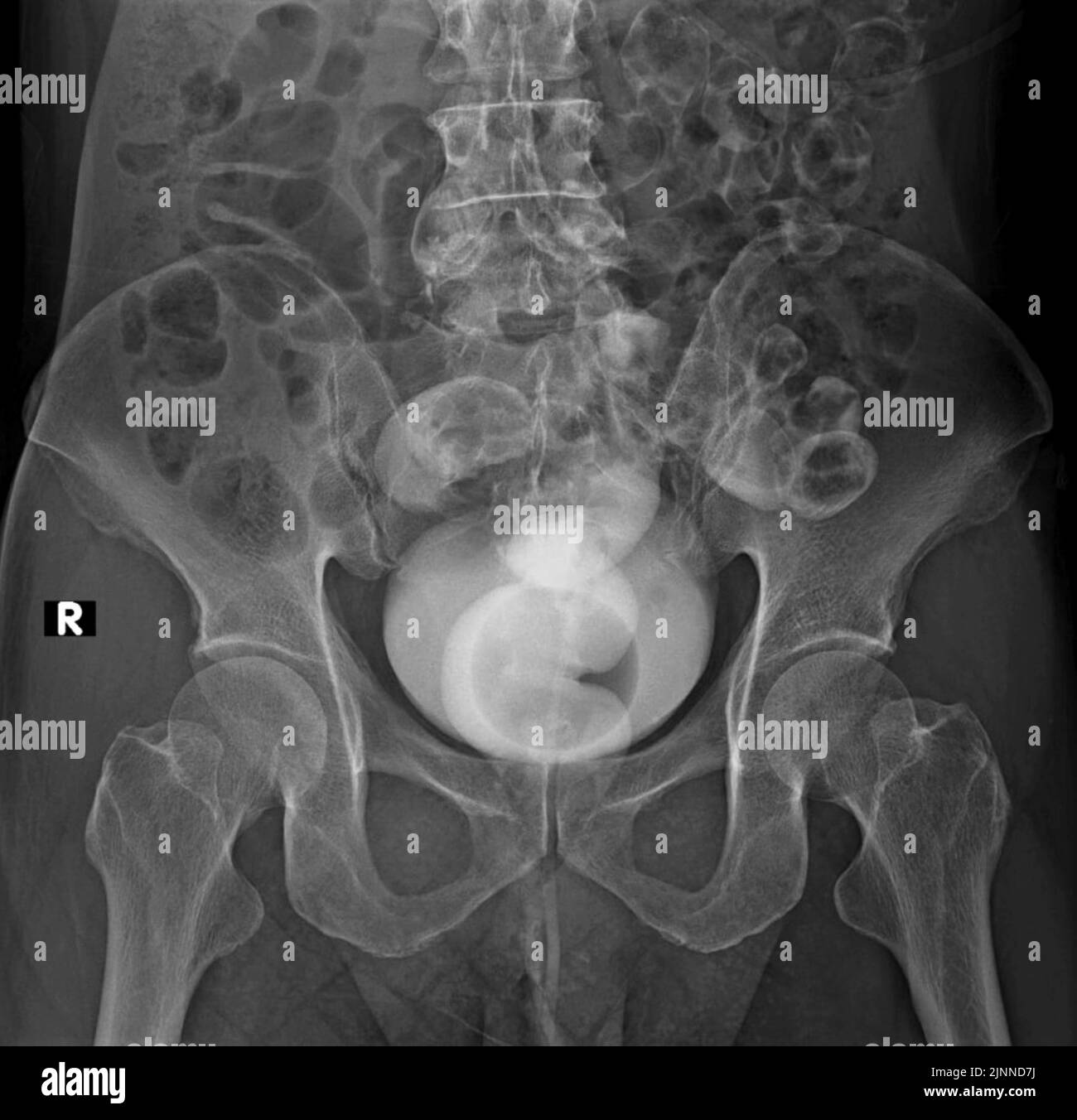 Rectovesical fistula, X-ray Stock Photo - Alamy