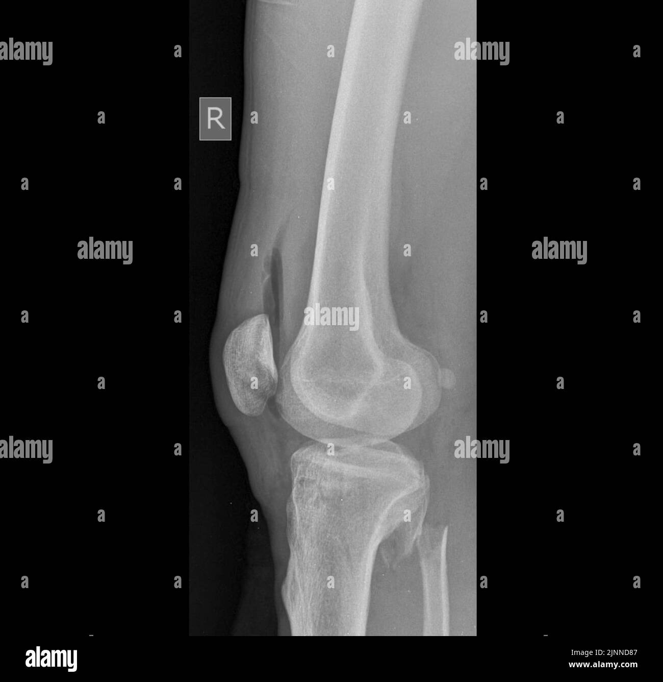 X ray bone scan Black and White Stock Photos & Images - Alamy