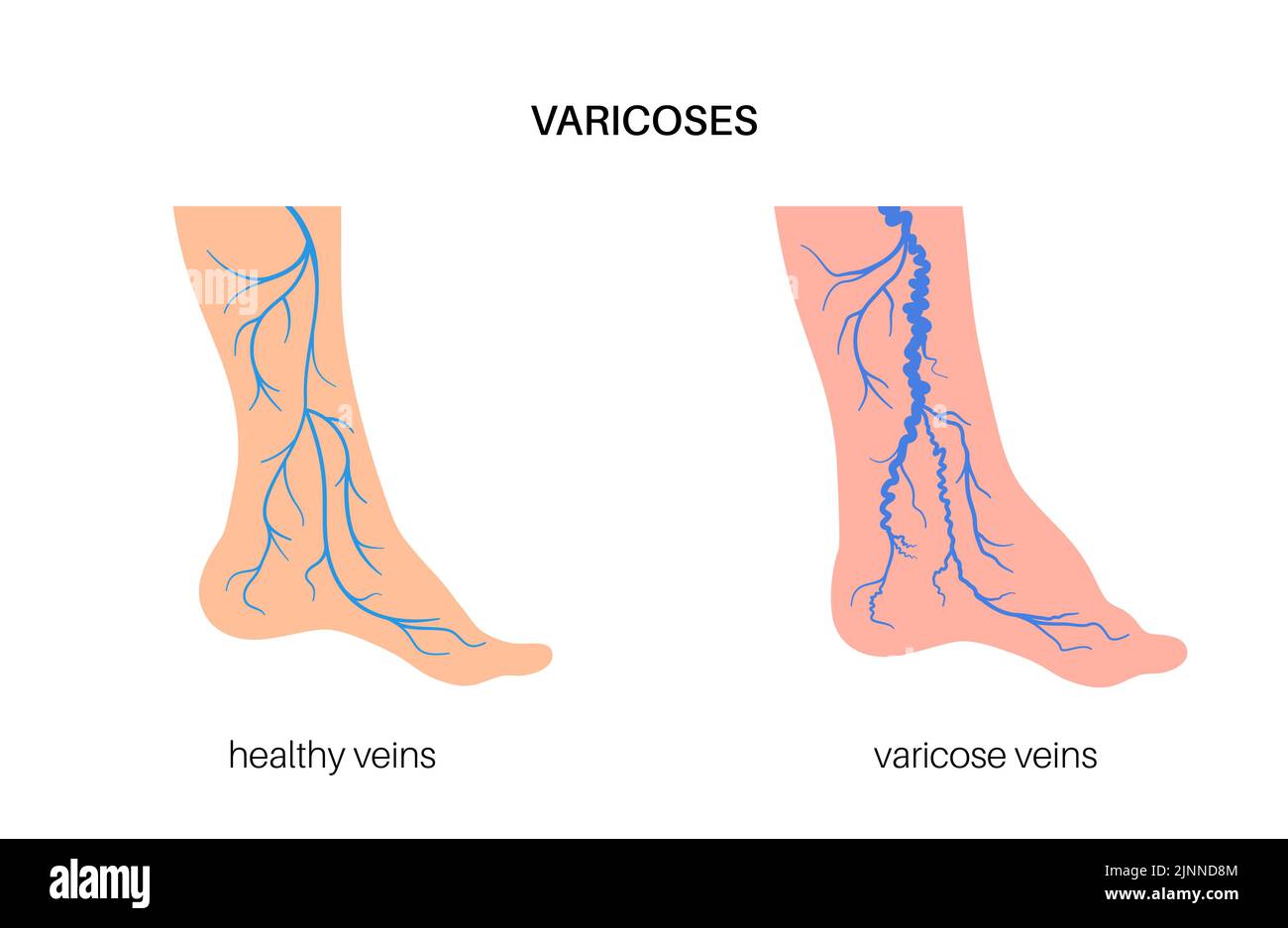 Varicose veins, illustration Stock Photo - Alamy