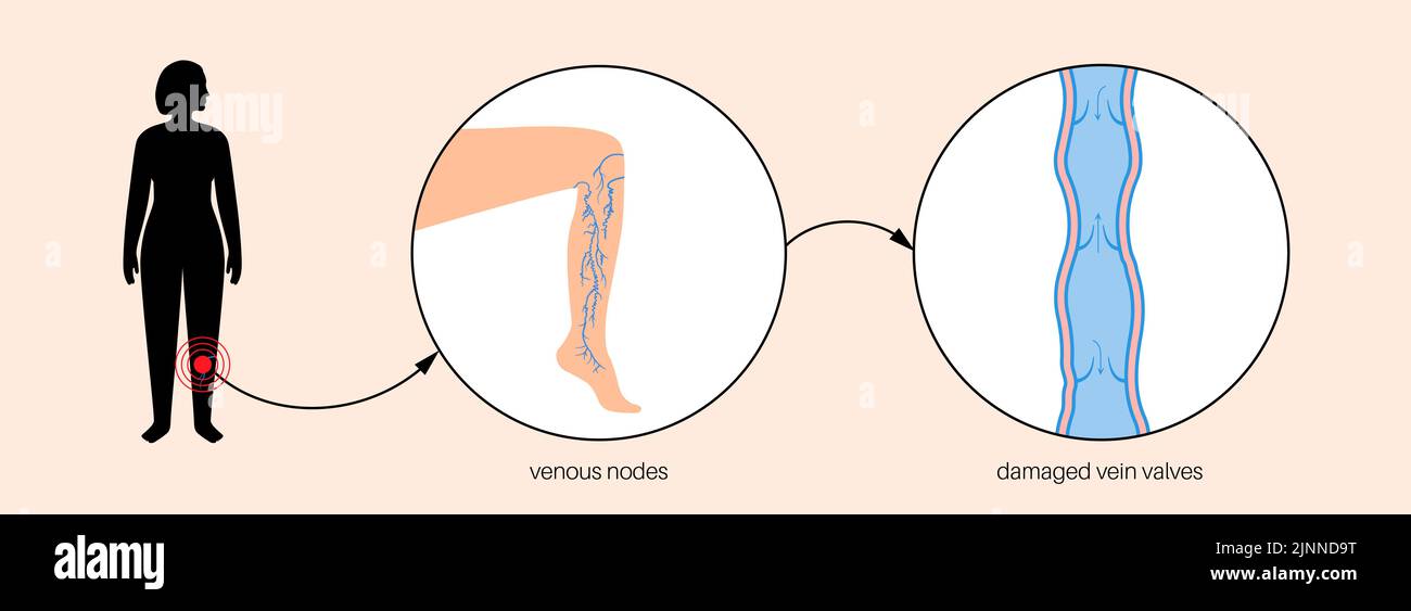 Varicose veins, illustration Stock Photo - Alamy