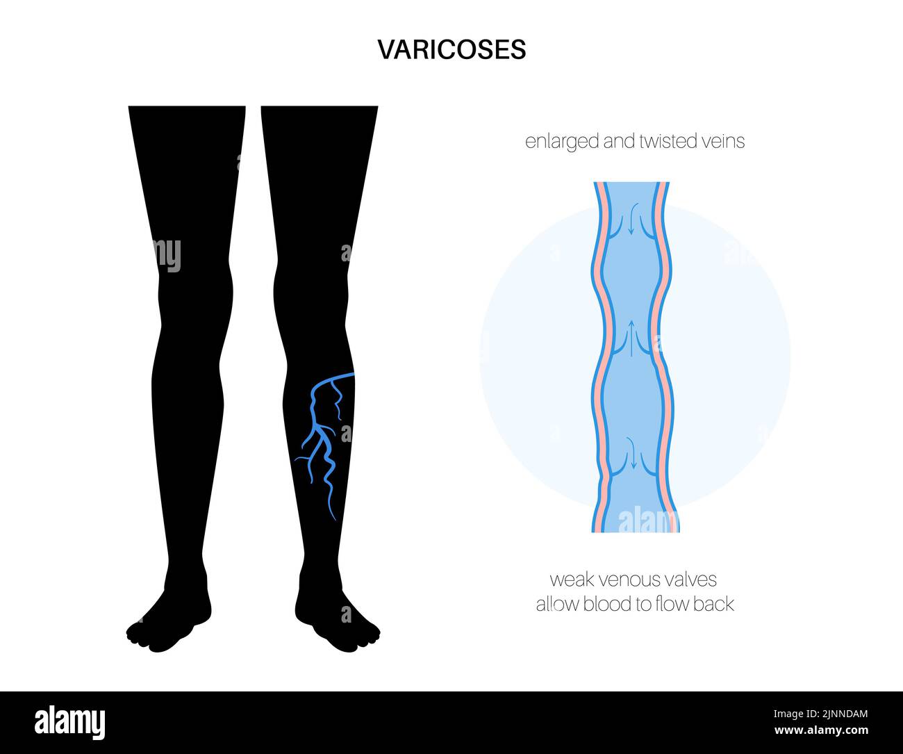 Varicose veins, illustration Stock Photo - Alamy