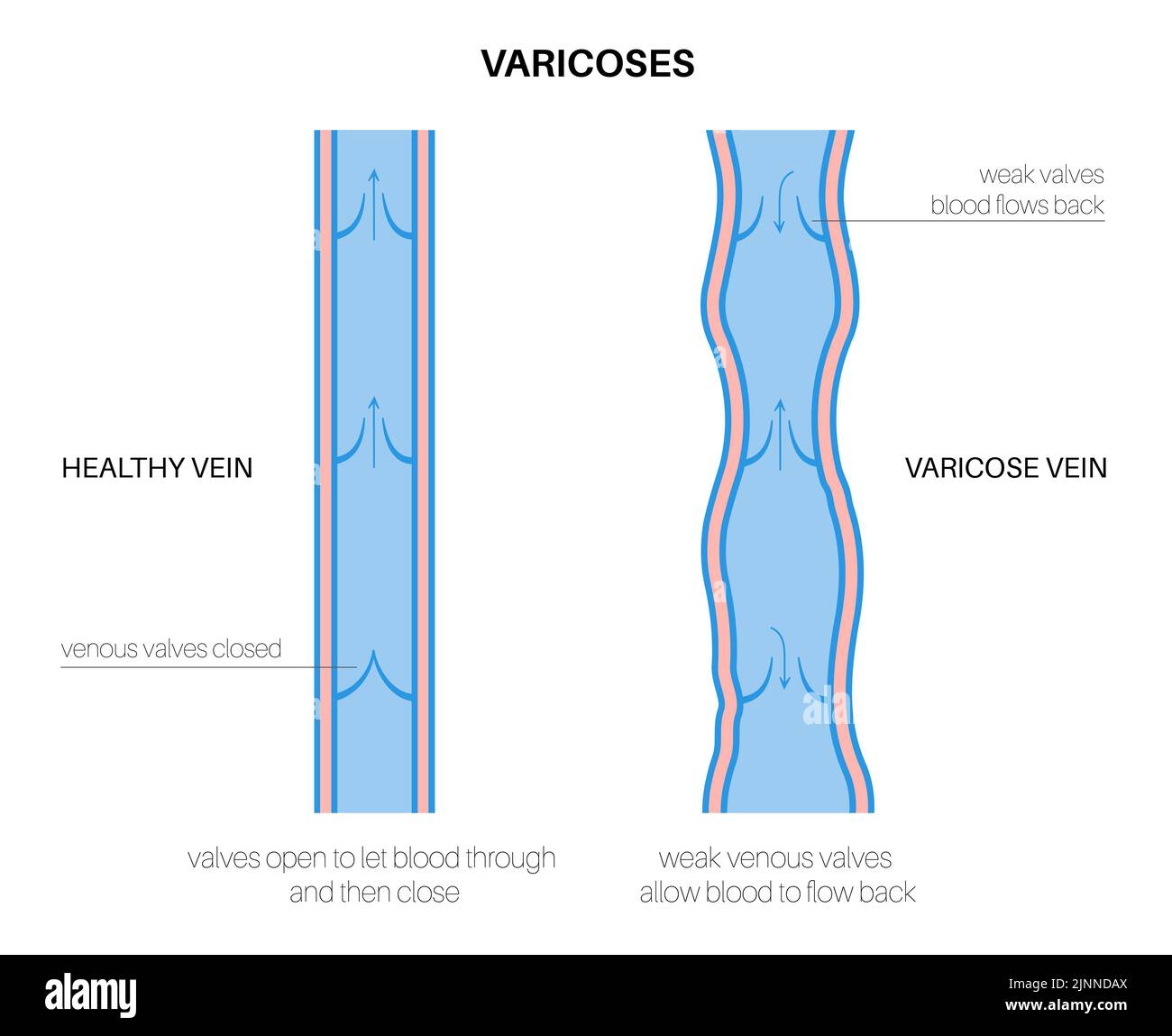 Varicose veins, illustration Stock Photo - Alamy