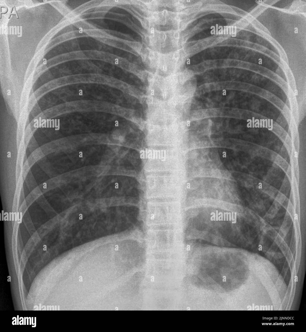 Lung abscess, X-ray Stock Photo - Alamy