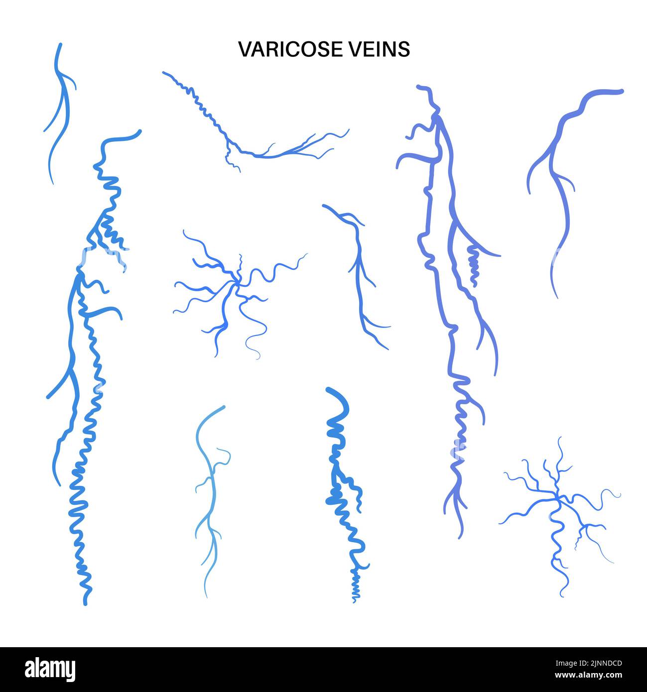 Varicose veins, illustration Stock Photo - Alamy