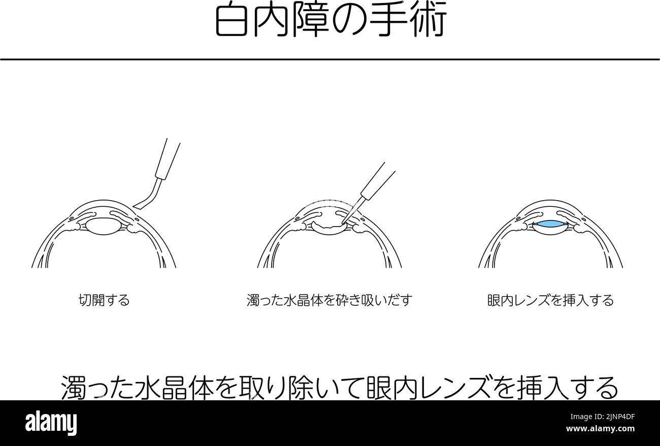 Illustrations, Cataract surgery, Medical Illustrations. - Translation ...