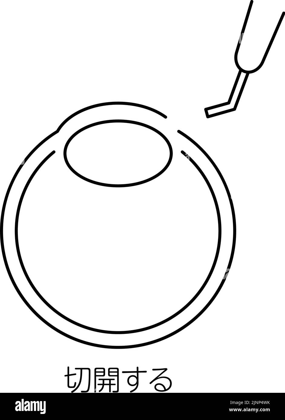 Cataract Surgery Process, Illustration (line drawing), Making an ...