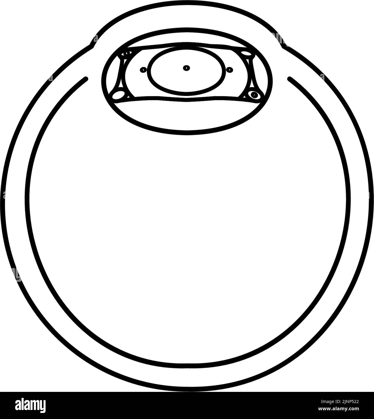 Illustration of ICL (intraocular contact lens) surgery and ICL fixation ...