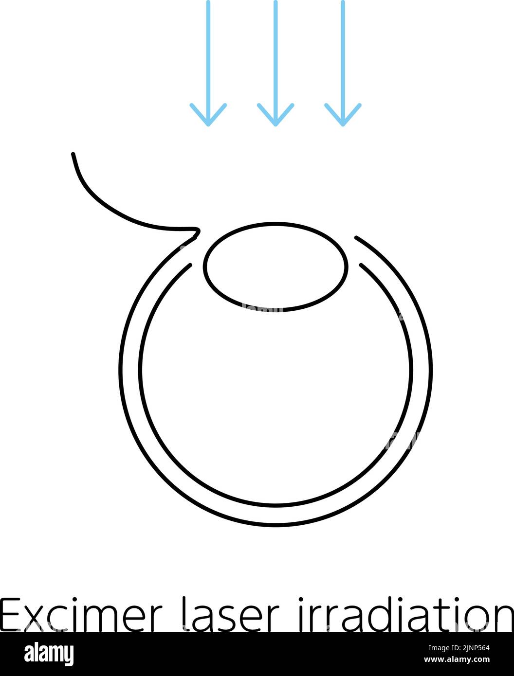 Medical illustration of LASIK and refractive surgery Stock Vector Image ...