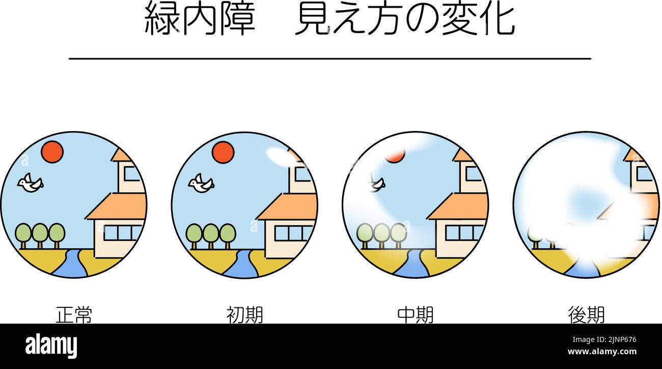 Illustration of glaucoma, changes in visual field as glaucoma ...