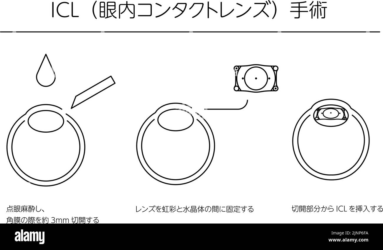 ICL (Intraocular Contact Lens) Surgery, illustrated - Translation:ICL ...