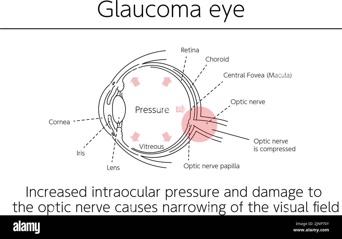 Glaucoma diagram hi-res stock photography and images - Alamy