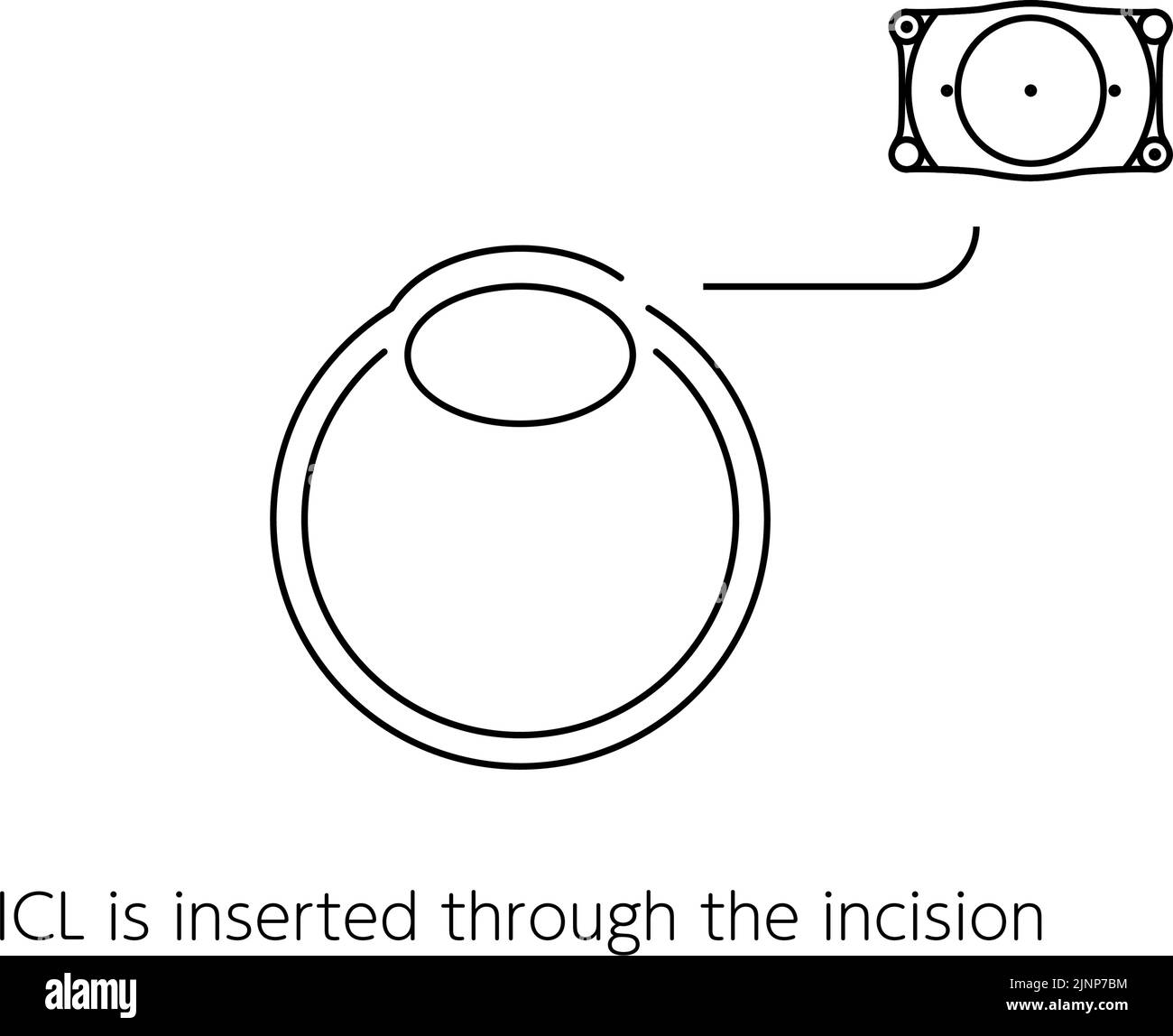 Illustration of ICL (intraocular contact lens) surgery and ICL ...