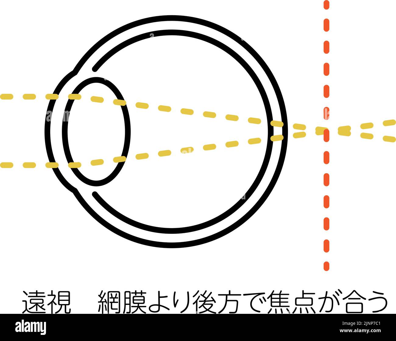 Medical Illustration of Visual Acuity and Refractive Error, Hyperopia ...