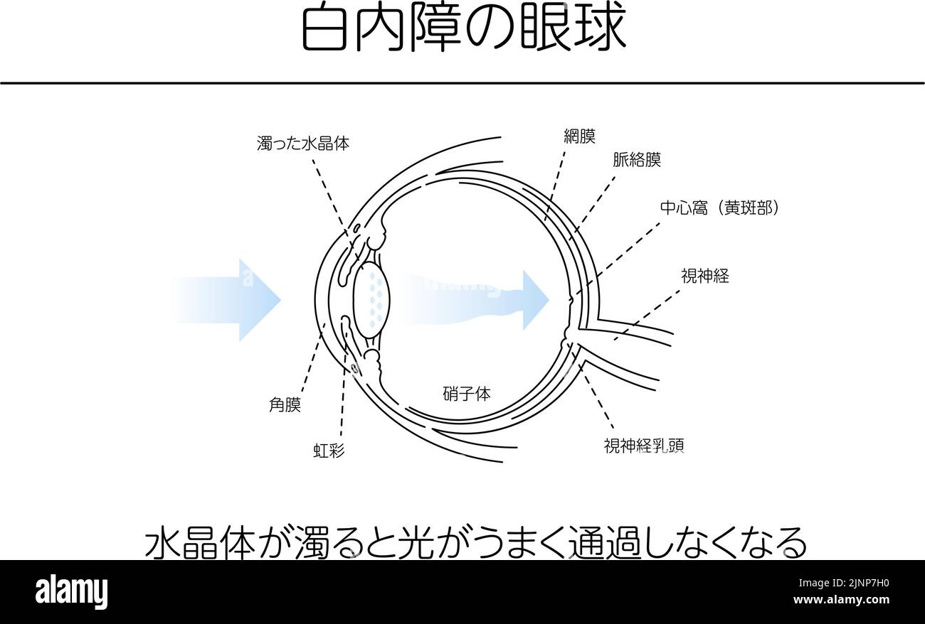 Illustration, Cataract eye, Medical Illustrations. - Translation ...