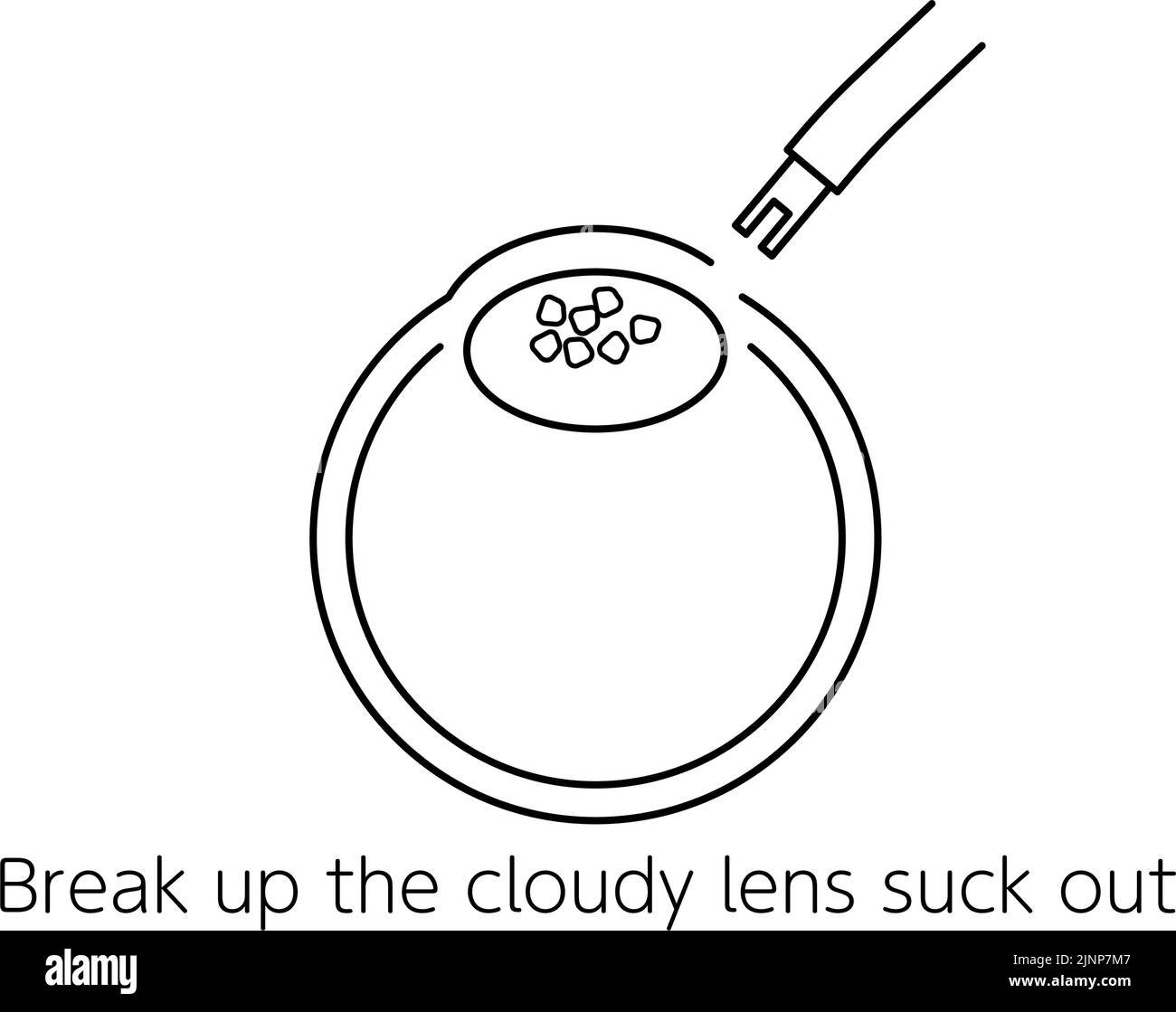 Cataract Surgery Process, Illustration (Line Drawing), Sucking Out the ...