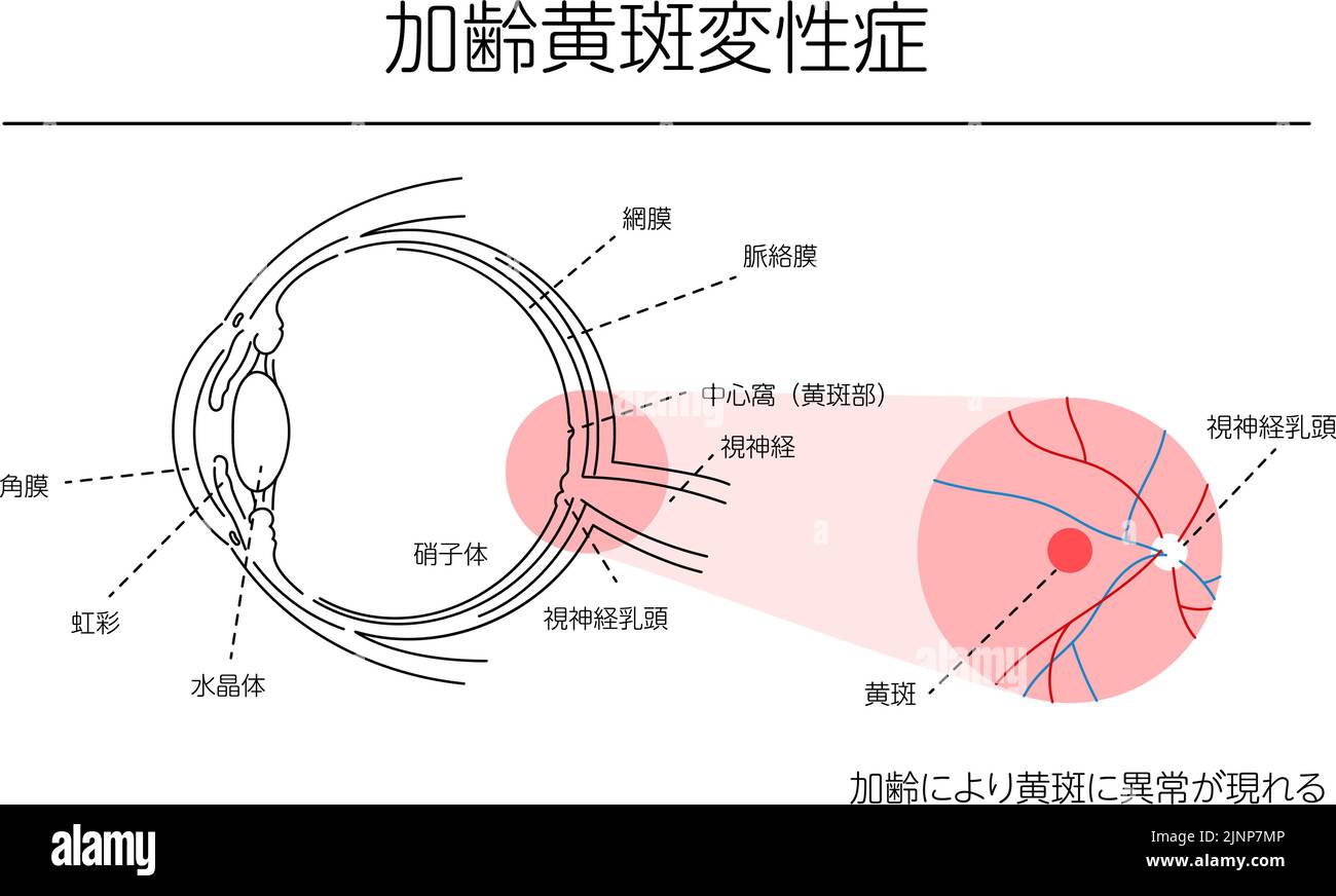 Illustration of eye disease, age-related macular degeneration ...