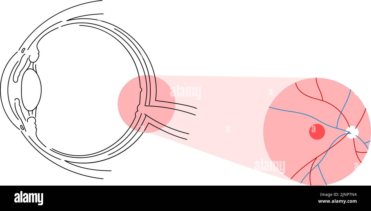Illustration of eye disease, age-related macular degeneration Stock ...