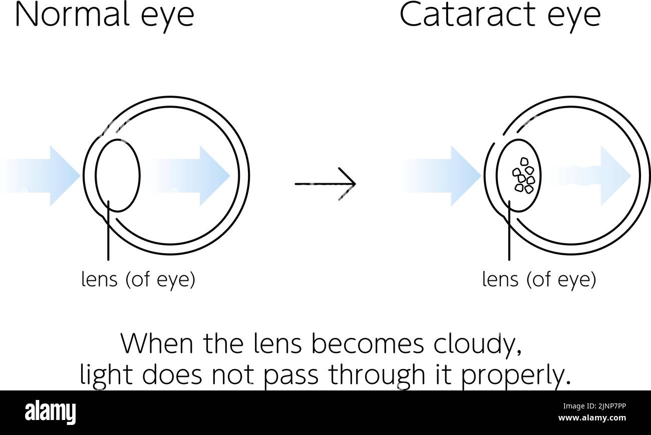 Normal retina hi-res stock photography and images - Alamy