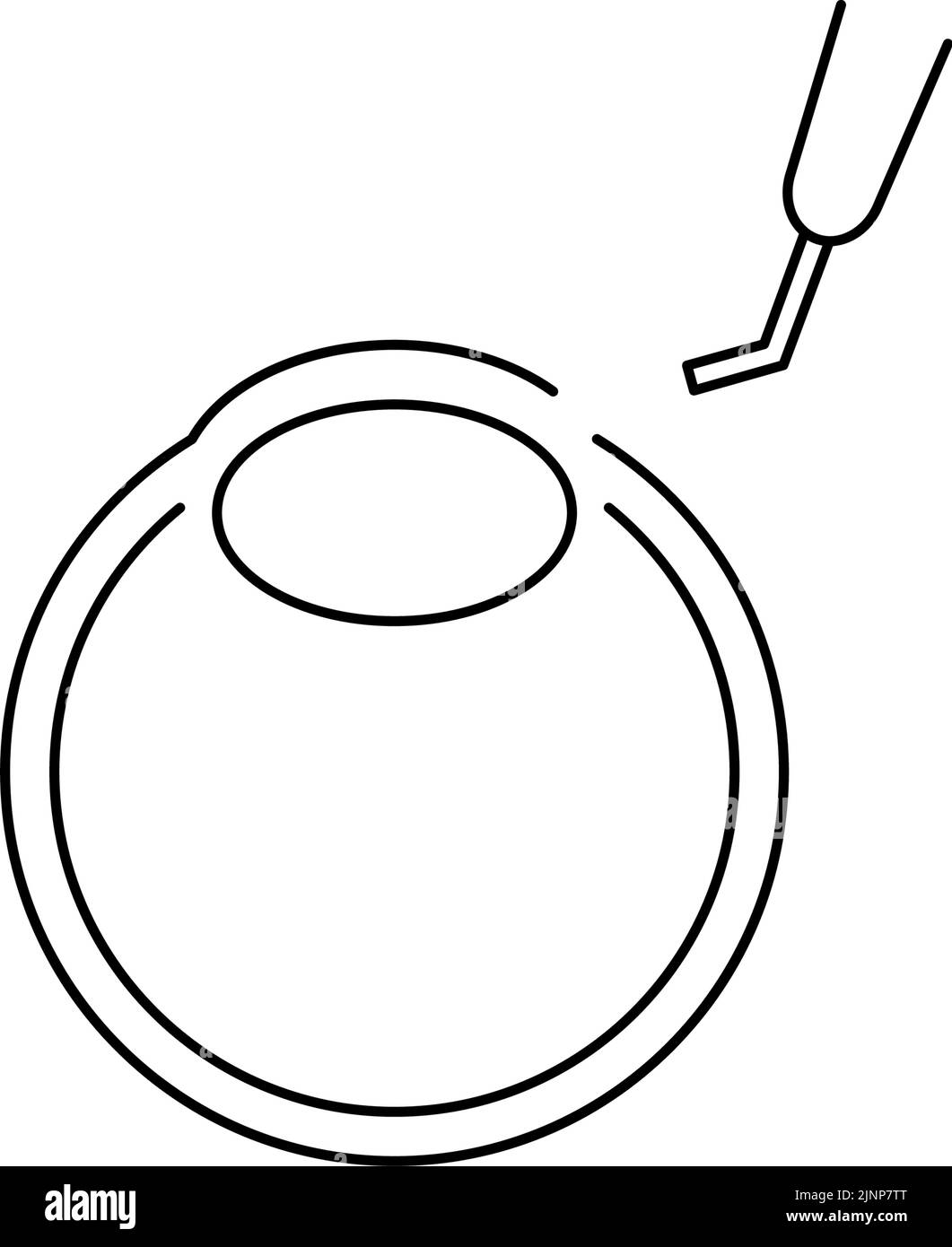 Cataract Surgery Process, Illustration (line drawing), Making an ...