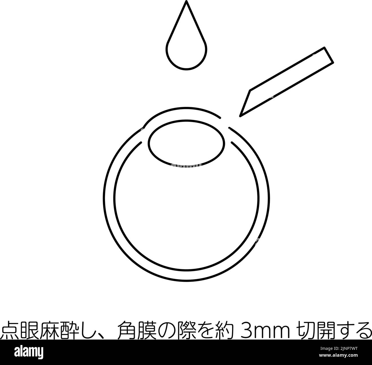 Illustration of ICL (intraocular contact lens) surgery and incision ...